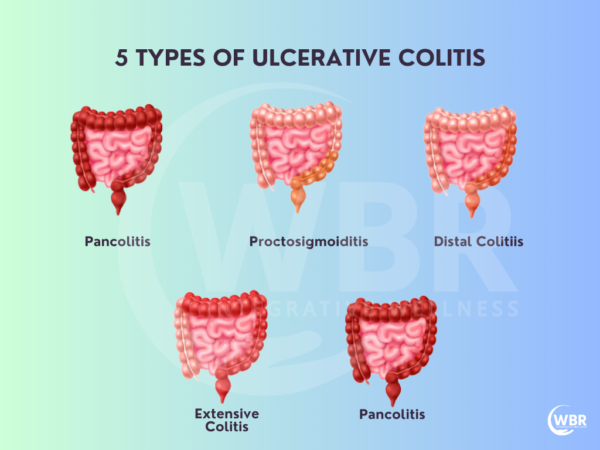 Functional Medicine Approach For Ulcerative Colitis - Wellness By Rosh ...
